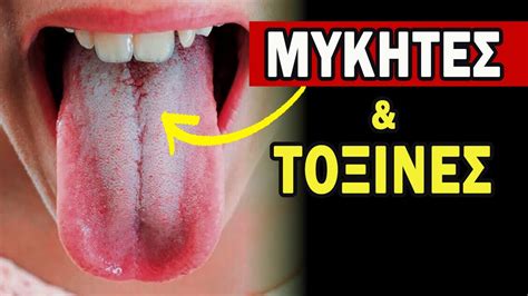 Θα Καταστραφούν Οι Μύκητες Στο Σώμα 100 ΑΠΟΤΟΞΙΝΩΣΗ Ακαδημία Υγείας Youtube