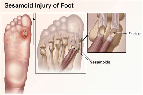 Sesamoiditis Ortho Design