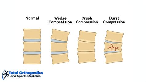 Burst Fracture Vs Compression Fracture