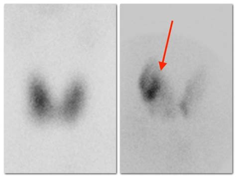 The Riddle Of Thyroid Nodules Neighborhood Radiologist