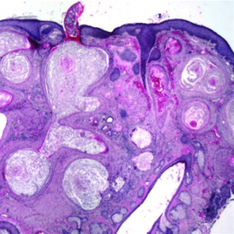 Histopathological Features Of The Trichoadenoma Lesion Featured In