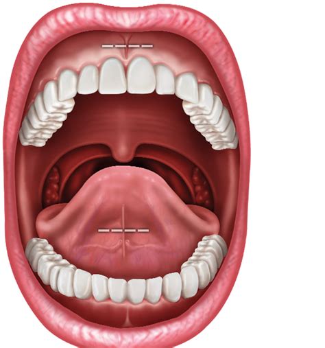 Labial Frenectomy