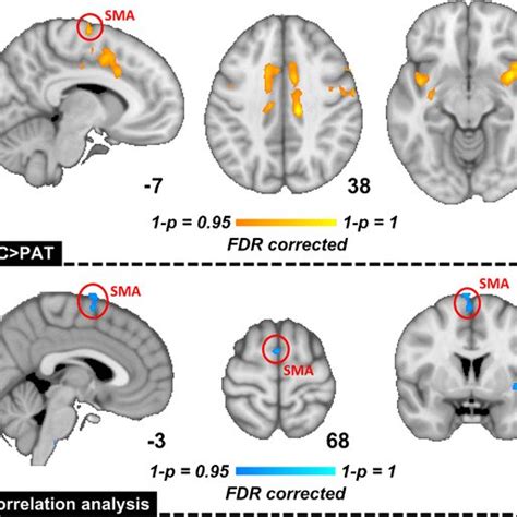 The Abnormal Functional Connectivity In Esrd Compared With Healthy Download Scientific Diagram