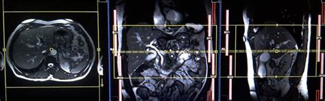 МР холангиопанкреатография