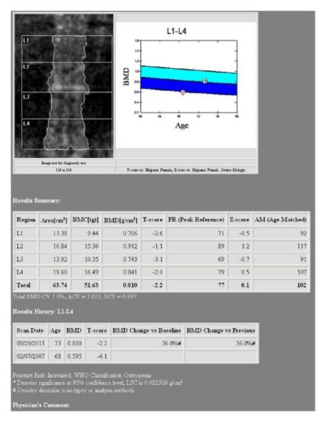 Osteoporosis Compression Deformity Of L 2 On Ap A And Lateral View