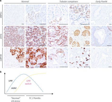 Downregulation Of Upr Proteins Expression During Pdac Initiation A