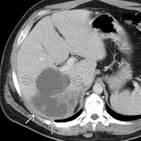 Biloma Clinical Gate
