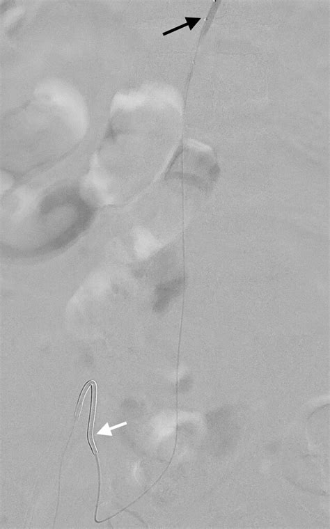 Transvenous Embolization Of Conus Spinal Arteriovenous Malformation Illustrative Case In