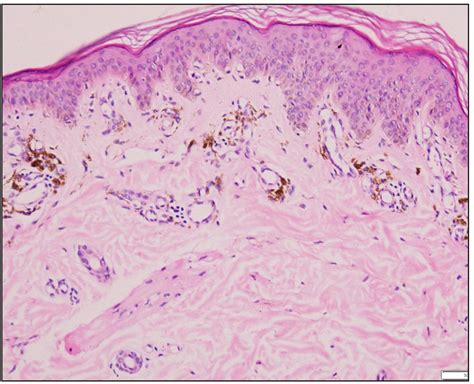Acquired Dermal Macular Hyperpigmentation Secondary To Bangles An