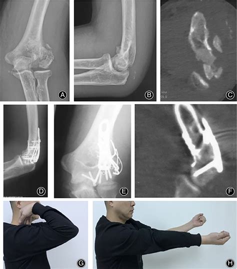 A 36‐year‐old Male Patient With Capitellar Fractures Dubberley Iiib Download Scientific