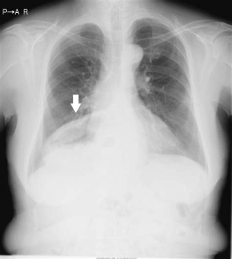 Upper Gastrointestinal Series A B Shows The Gastric Volvulus In