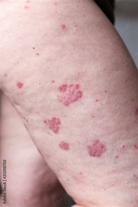 Psoriasis Vulgaris Is An Autoimmune Disease That Affects The Skin Detail Photography For Mainly