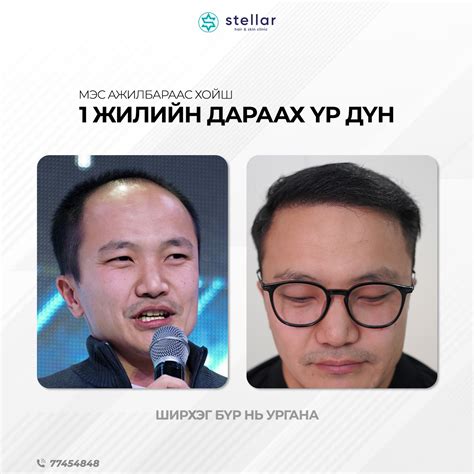 🌟Үс шилжүүлэн суулгах мэс Stellar Hair And Skin Clinic