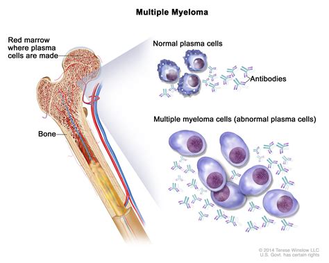 Definition Of Plasma Cell Myeloma Nci Dictionary Of Cancer Terms Nci