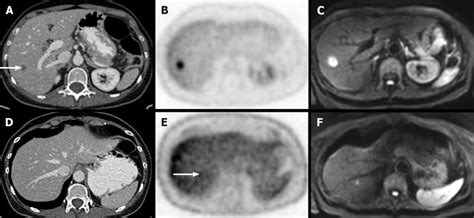 a 65 year old woman with colorectal carcinoma shows liver metastasis in