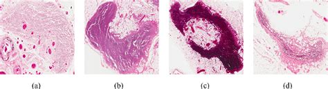 Figure 1 From Automatic Lymph Node Classification With Convolutional Neural Network Semantic