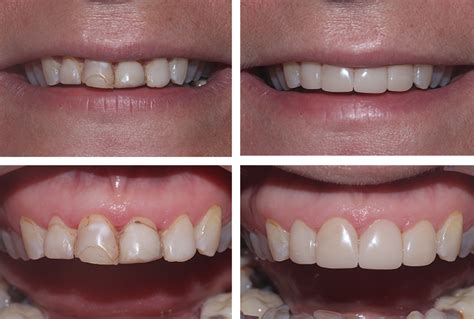 Bioclear Matrix For Dentists Uk