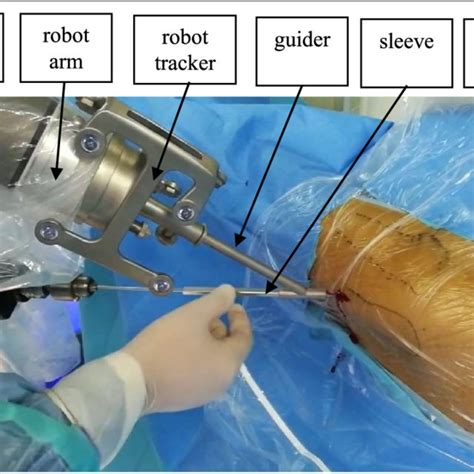 Pdf The Effect Of Robot Navigation Assisted Core Decompression On