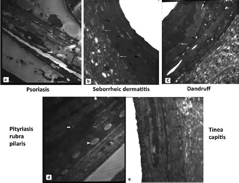 Dandruff Flake Under Microscope