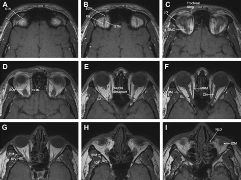 Orbit Mri Anatomy