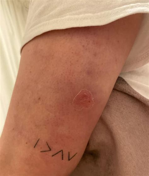 Sitecannula Problems Romnipod