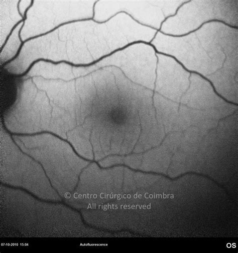 Clinical Case 1 Atlas Rl Eye