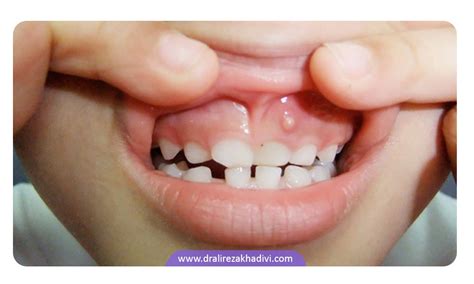 علت عفونت لثه در کودکان با راهکارهای درمانی دندانپزشک