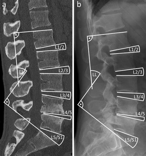 Measurement Of Intersegmental And Ll Angles In A A Ct Scan And B Download Scientific