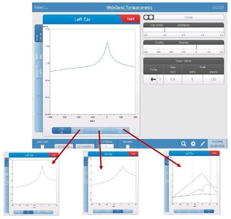 Wideband Tympanometry Overview Gsi Blog