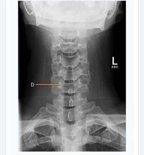 Cervical Spine Flashcards Quizlet