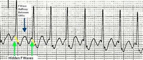 10 Tips To Diagnose Atrial Flutter On An Ekg