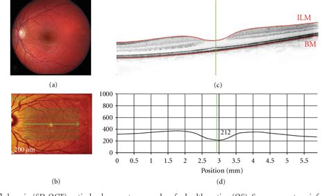 Figure 1 From High Resolution Optical Coherence Tomography Retinal