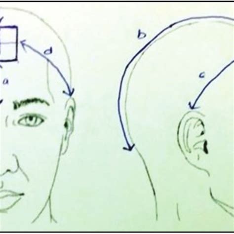 Area On Vertex Of The Scalp To Be Used For Hair Count Same Distance