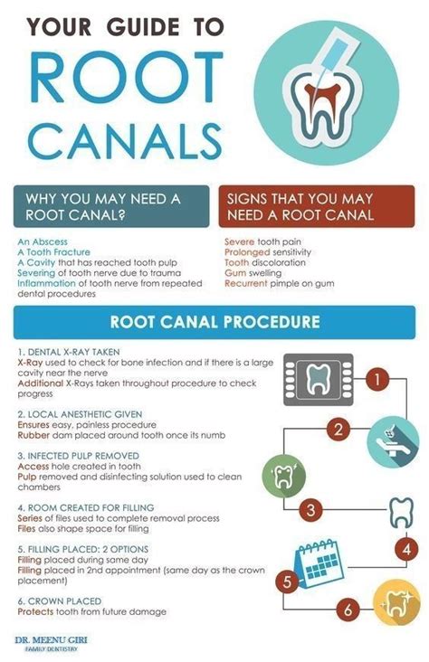 Root Canal Treatment Best Dentists In Eugene Oregon Artofit