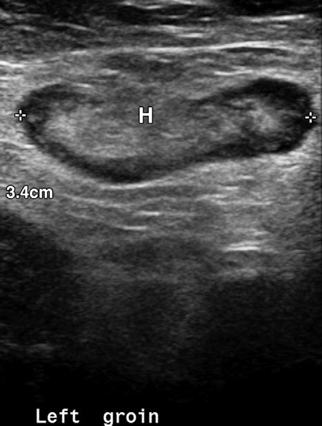 Reactive Lymph Node In A 51 Year Old Man With Lower Extremity Download Scientific Diagram