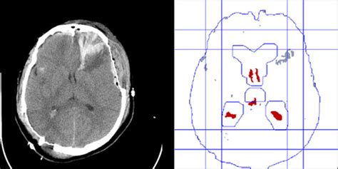 Automated Midline Shift And Intracranial Pressure Estimation Based On