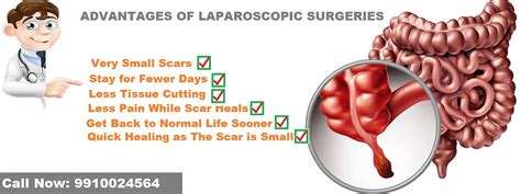 Appendix Symptoms And Treatment With Laparoscopic Surgery By Habilite Clinics Medium
