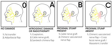 Reconstructive Algorithm For Facial Restoration After Parotidectomy