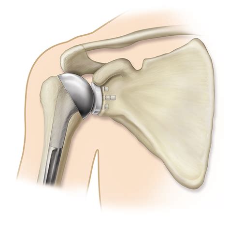 Shoulder Replacement Surgery Surgical Treatment Options Exactech