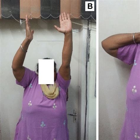 Proximal Humerus Fracture Operated With Deltopectoral Approach Dp Download Scientific Diagram