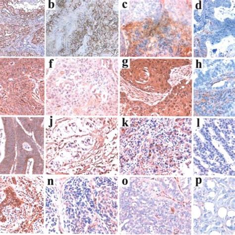 Podoplanin Expression In Diverse Types Of Cancer Cells A D Download Scientific Diagram