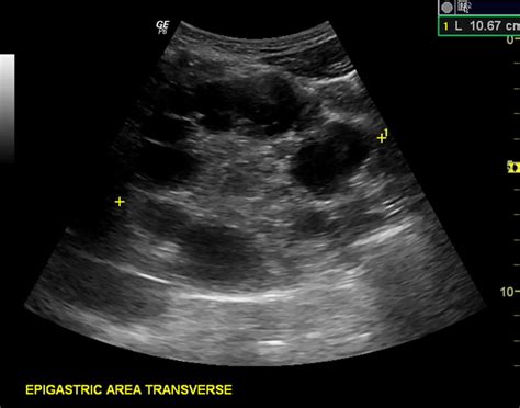Hydatid Cyst Causes Symptoms Diagnosis Treatment And Prognosis