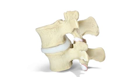 Anterolisthesis Lumbar Model Grade 1 L2 3