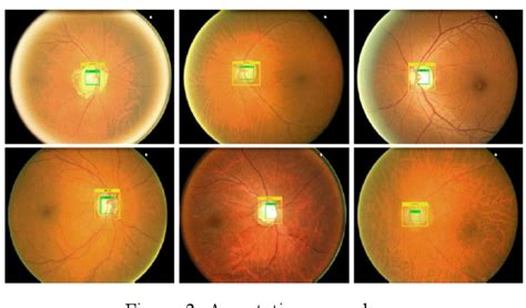 Figure 3 From An Automated Glaucoma Detection From Fundus Images Based On Deep Learning Network
