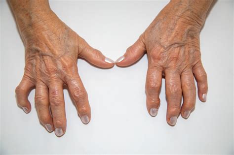 손의 관절염 흰색 배경에 고립되어 있습니다 늙은 여자의 손 60 64세에 대한 스톡 사진 및 기타 이미지 60 64세 65
