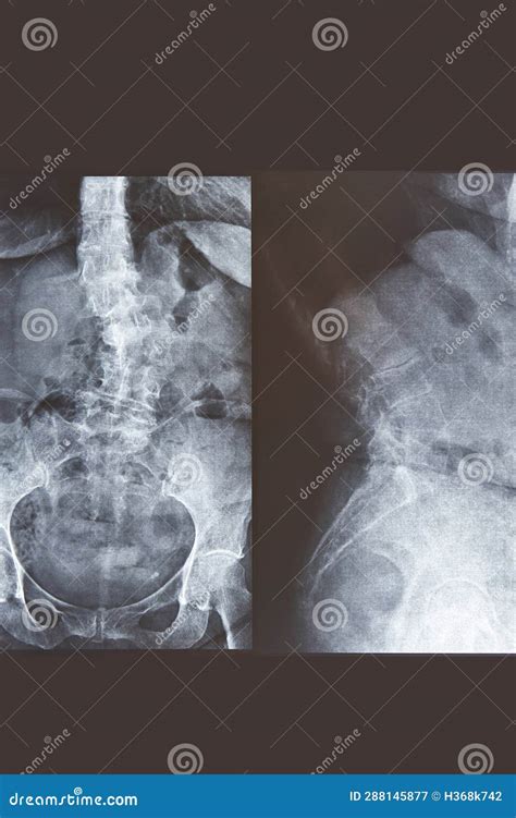 Lumbar Spine Xray Front And Lateral View Healthcare Examination