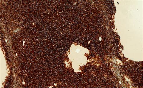 Cd138 Positive Staining Download Scientific Diagram