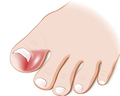 내성발톱 자가치료 방법 관련 병원 알아보기