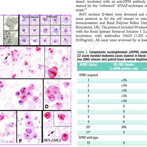 The Case Numbers Correspond To Table 1 A B Aml With Npm1 Mutation