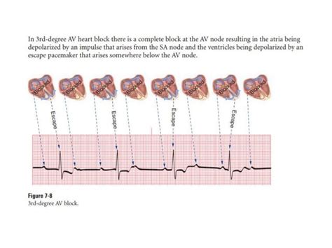P Wave In Ecg Abnormalities Of P Wave In Ecg Pptx Heart And Cardiovascular Diseases
